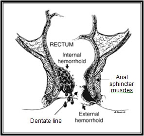 Hemorrhoidectomy | UCSF Department of Surgery